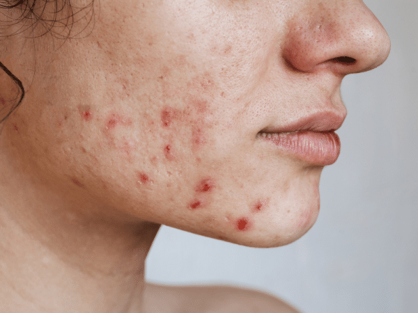 How Many Sessions of Microneedling Are Needed for Scar Reduction ...